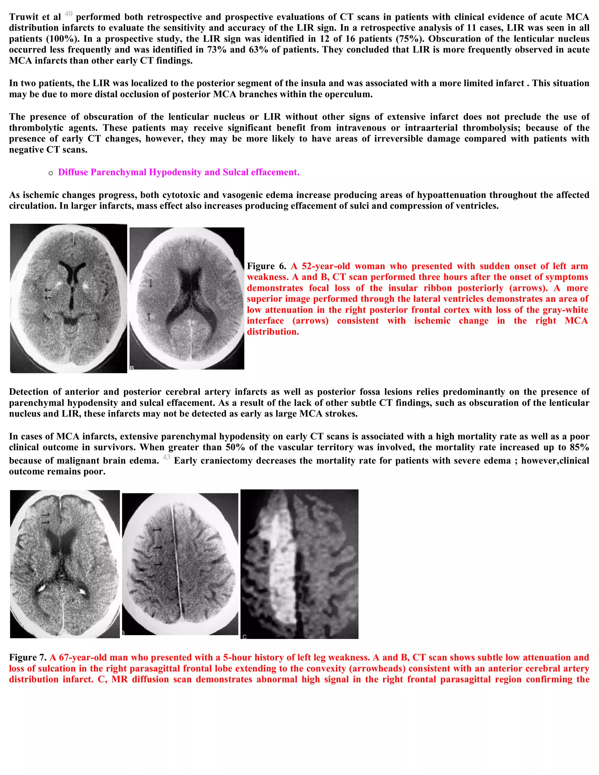 Topic of the month...Neuroimaging of embolic cerebral infarctions | PDF