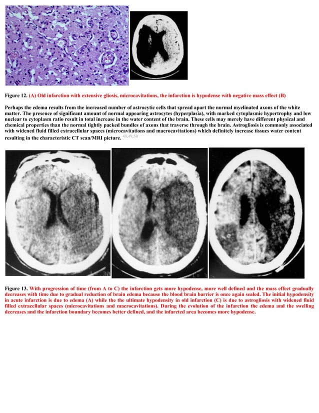 Topic of the month...Neuroimaging of embolic cerebral infarctions | PDF