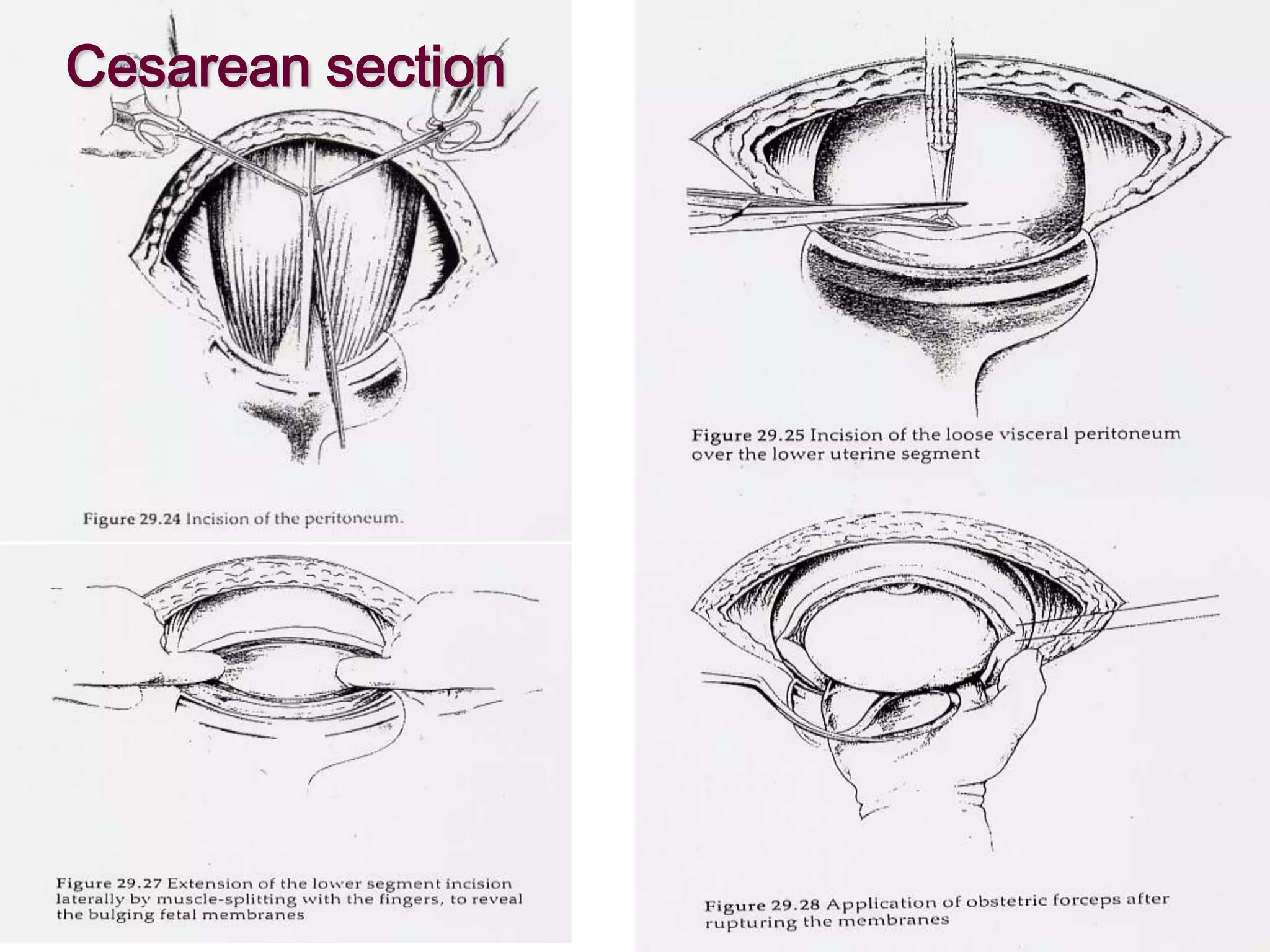 8. cesarean section | PPTX