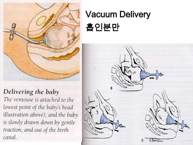8. cesarean section | PPTX