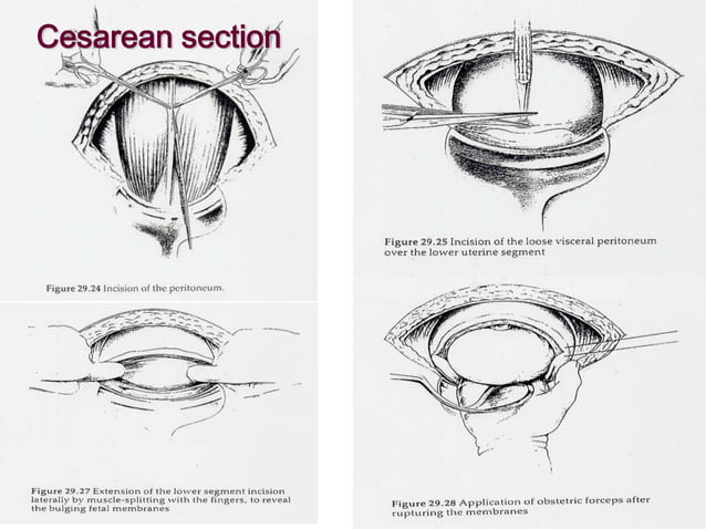 8. cesarean section | PPTX