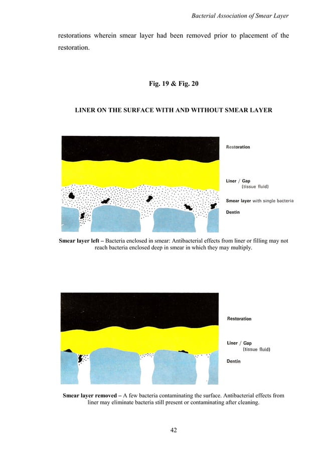 bacterial association of the smear layer/ rotary endodontic courses by ...