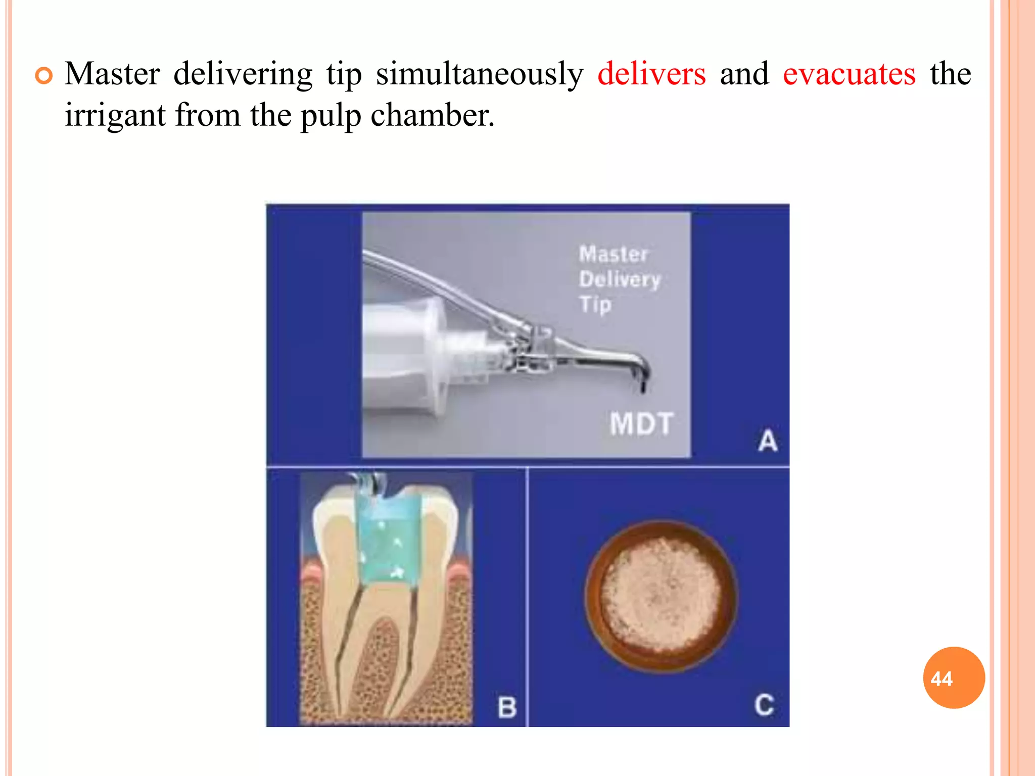 Recent advances in endodontic irrigation devices | PPTX