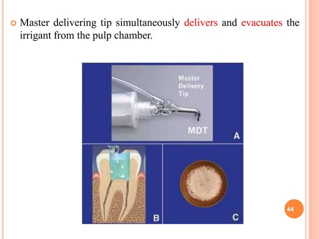 Recent advances in endodontic irrigation devices | PPTX