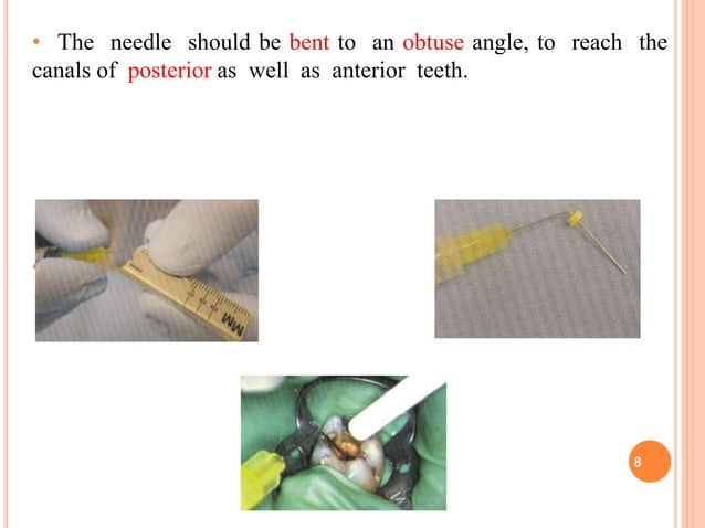 Recent advances in endodontic irrigation devices | PPTX