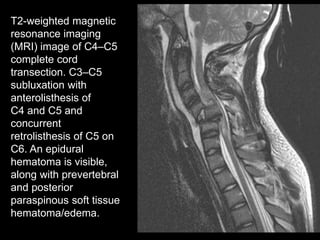 8. trauma raquimedular rx do trauma | PPTX