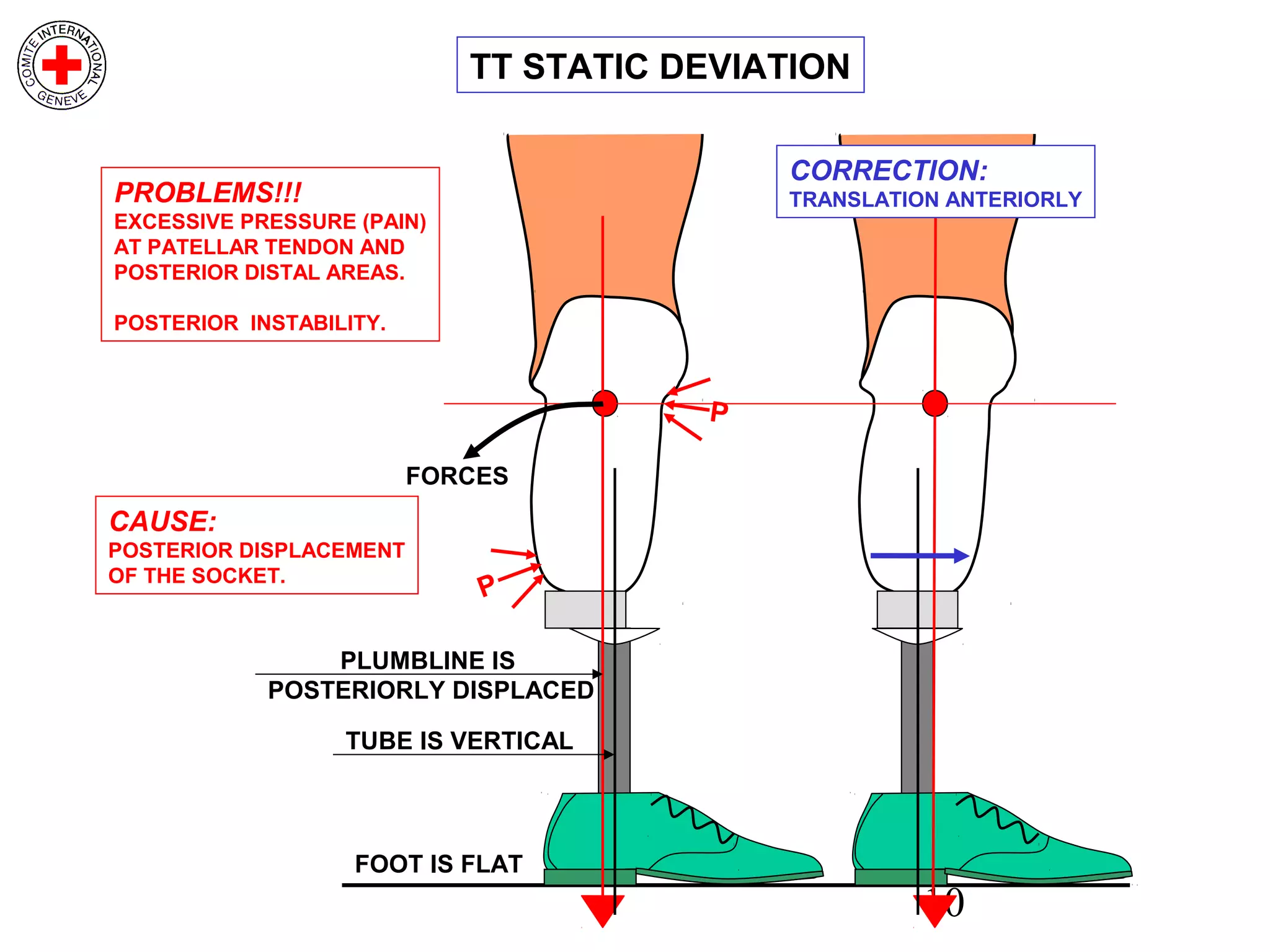 Transtibial Static Alignment | PPT