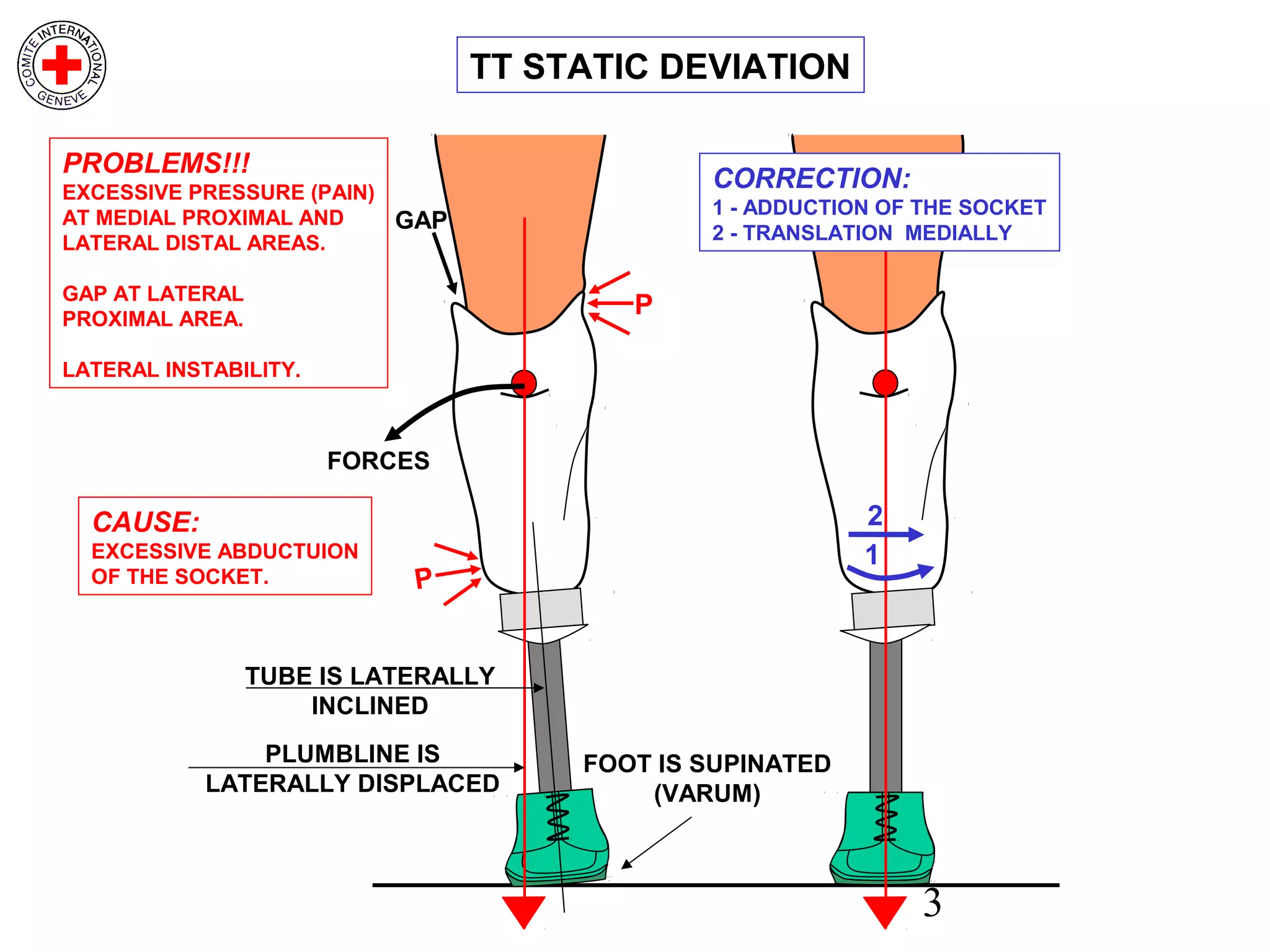 Transtibial Static Alignment | PPT