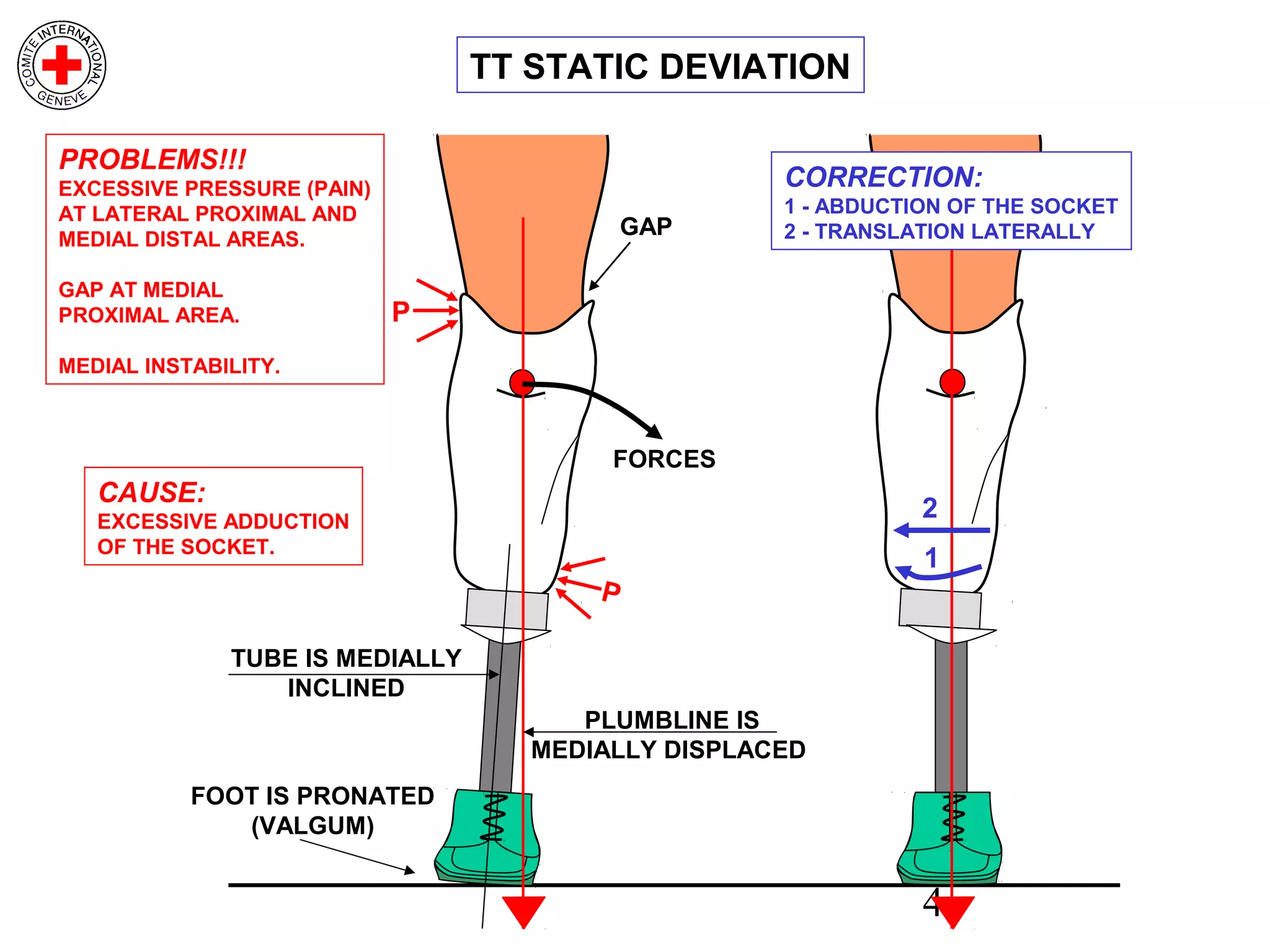 Transtibial Static Alignment | PPT