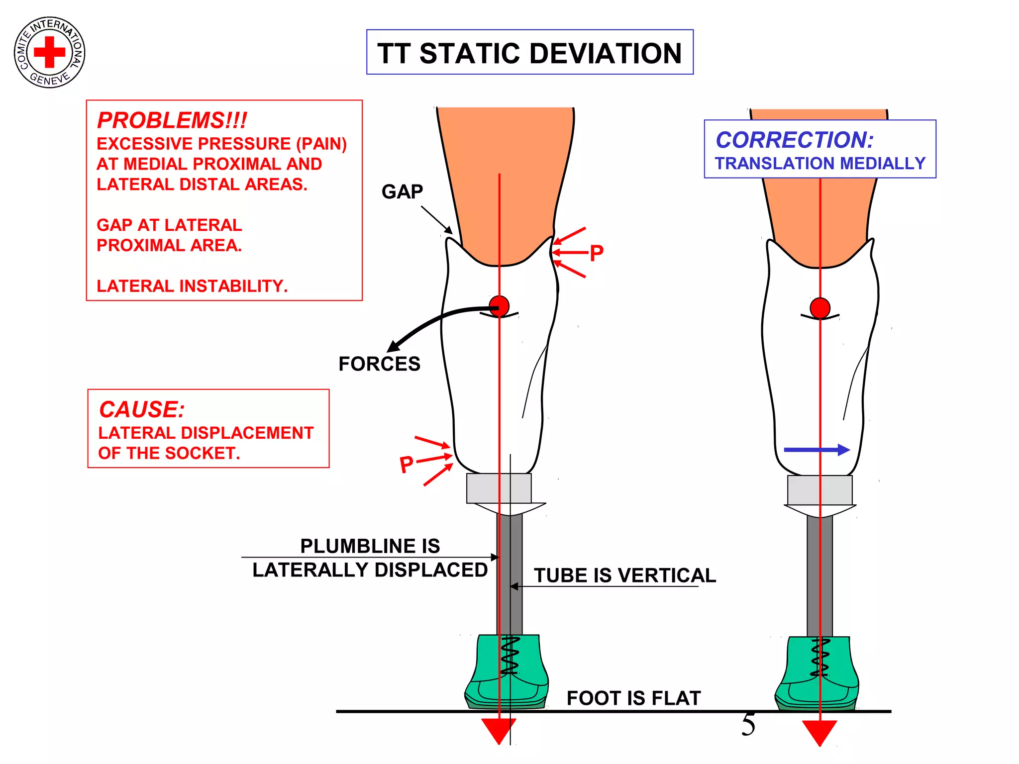 Transtibial Static Alignment | PPT