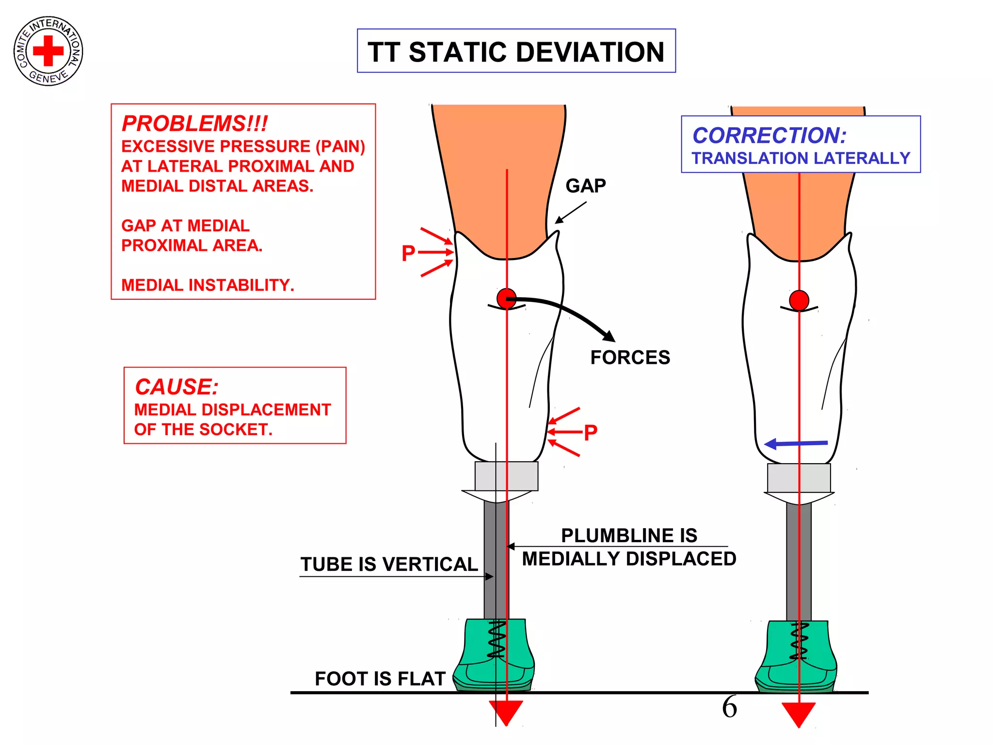 Transtibial Static Alignment | PPT