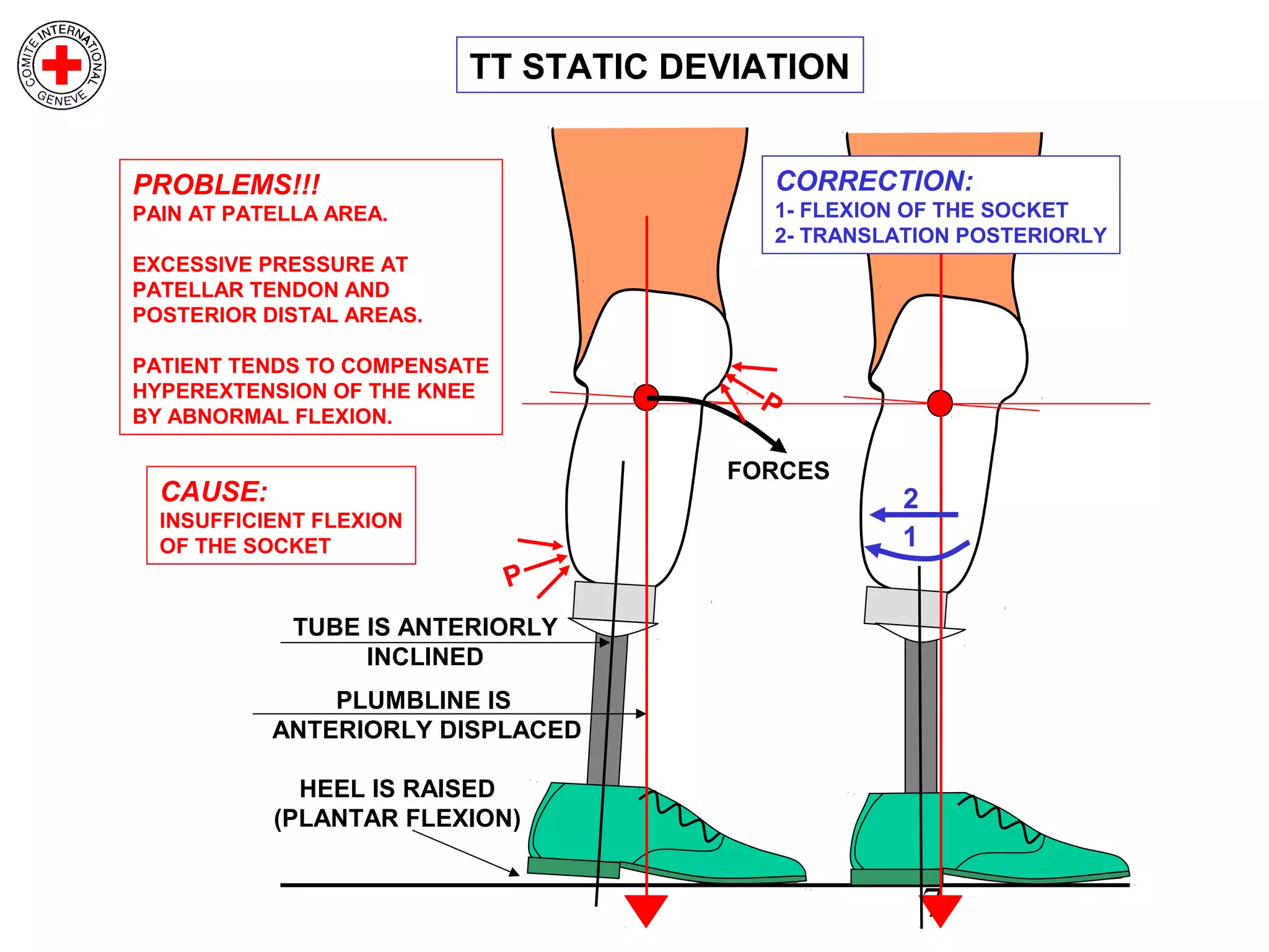 Transtibial Static Alignment | PPT