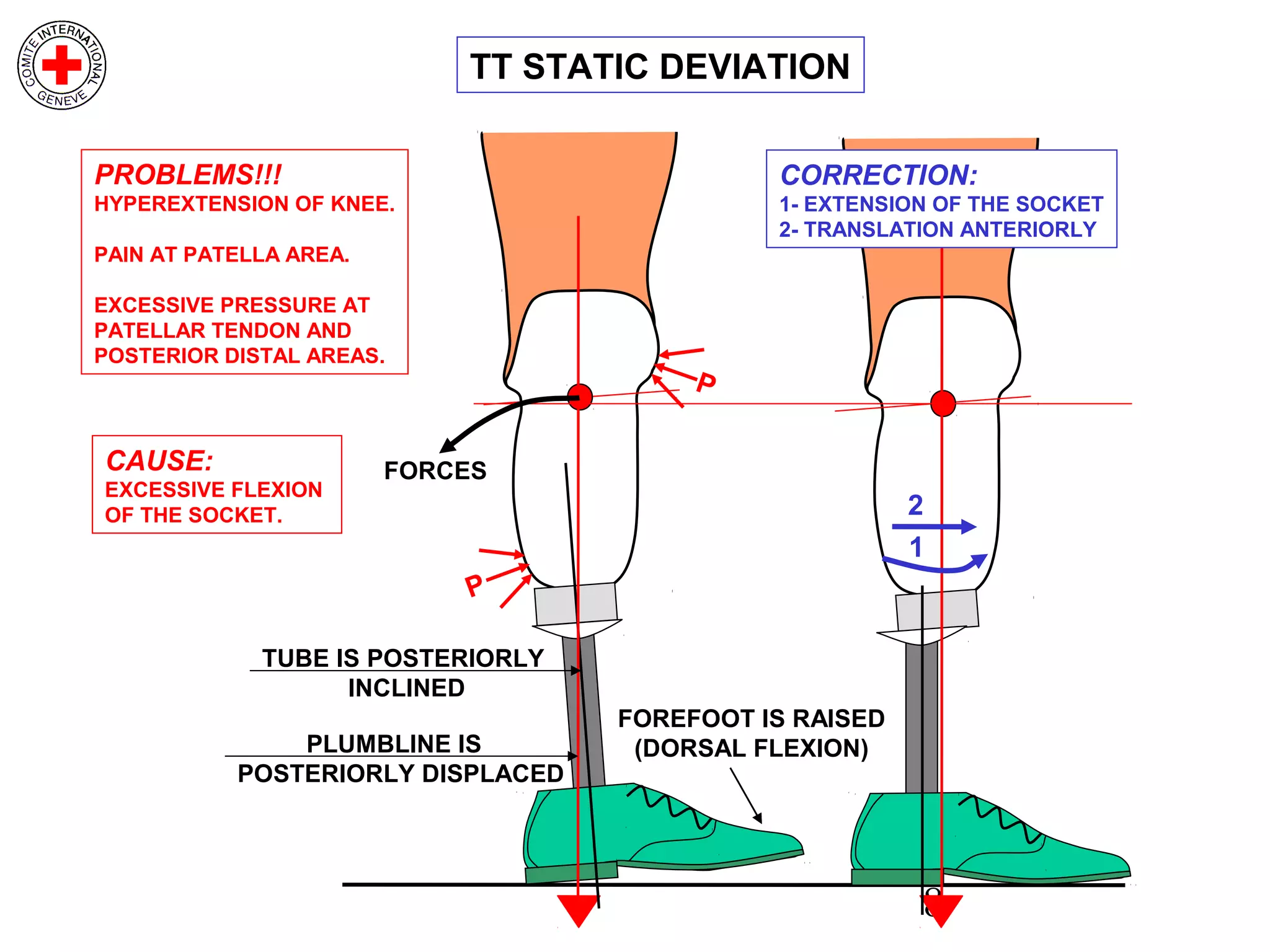 Transtibial Static Alignment | PPT