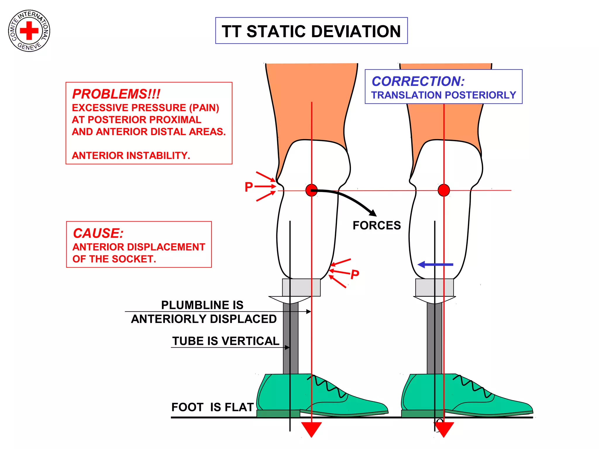 Transtibial Static Alignment | PPT