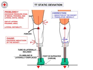Transtibial Static Alignment | PPT