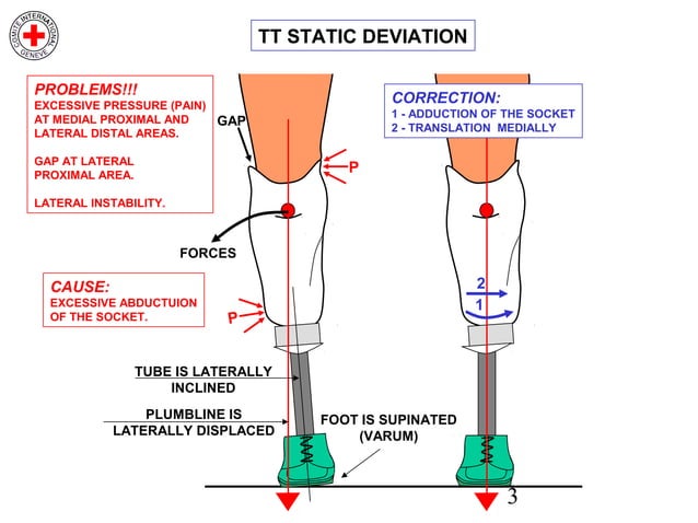 Transtibial Static Alignment | PPT
