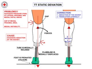 Transtibial Static Alignment | PPT