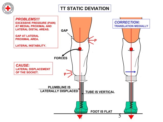 Transtibial Static Alignment | PPT