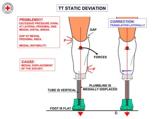 Transtibial Static Alignment | PPT