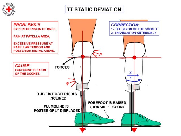 Transtibial Static Alignment | PPT