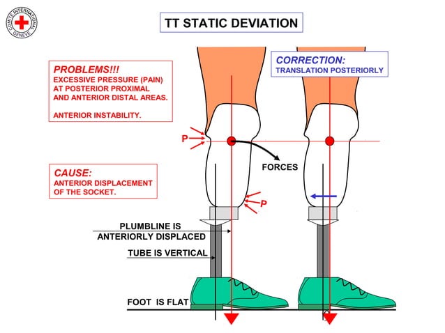 Transtibial Static Alignment | PPT