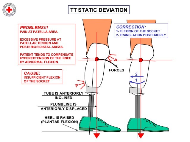 Transtibial Static Alignment