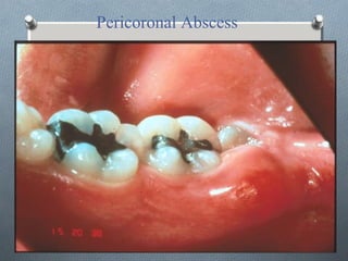 Pericoronal Abscess