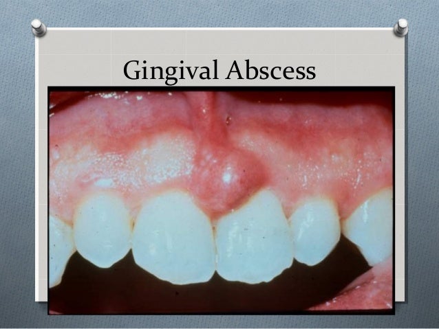 PERIODONTAL ABSCESS