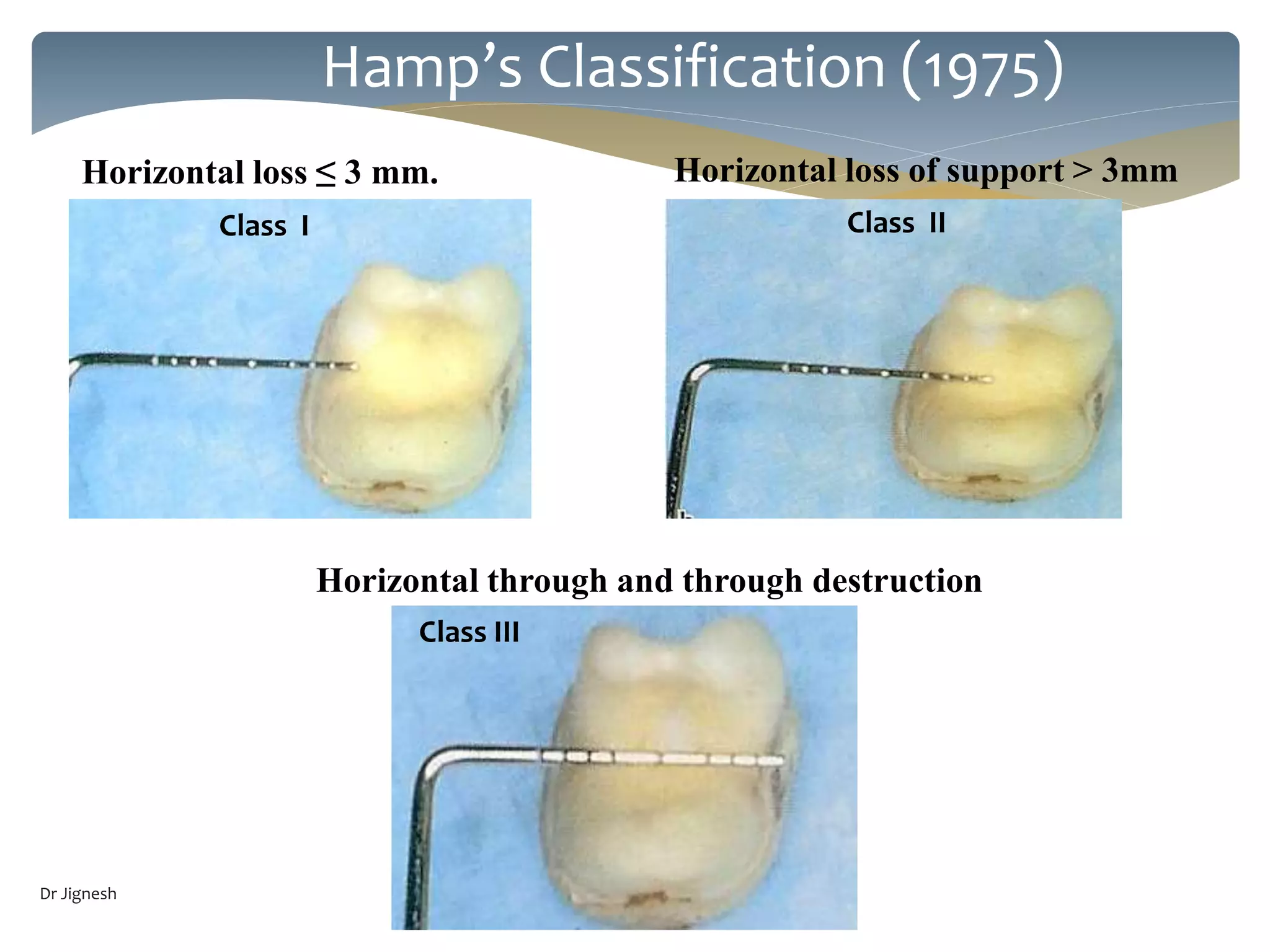 furcation involvement | PPTX