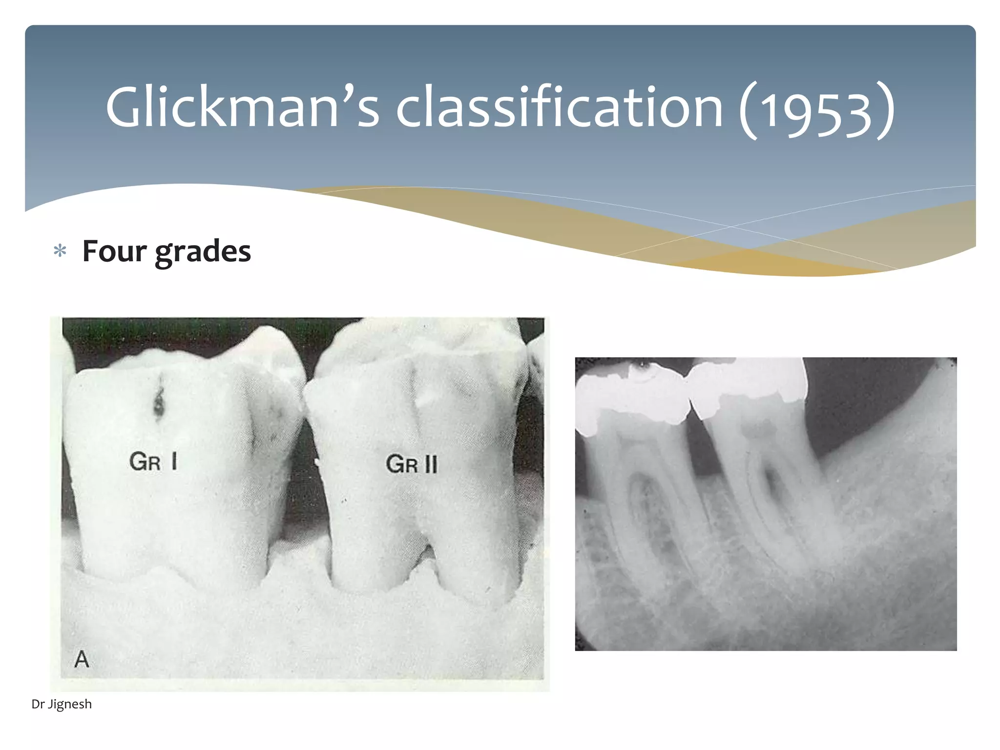 furcation involvement | PPTX
