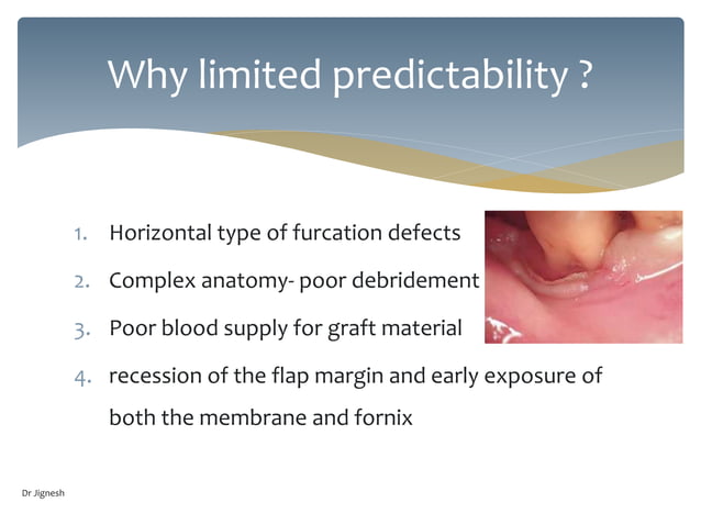 furcation involvement | PPTX