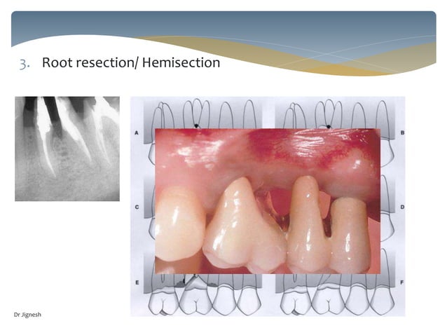 furcation involvement | PPT
