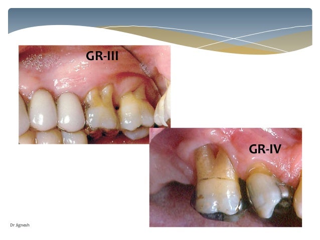 furcation involvement