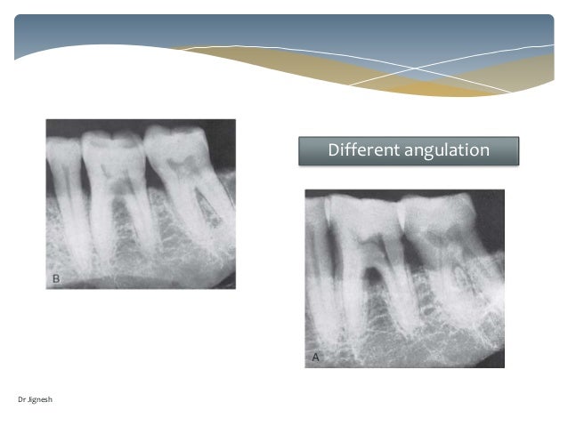 furcation involvement