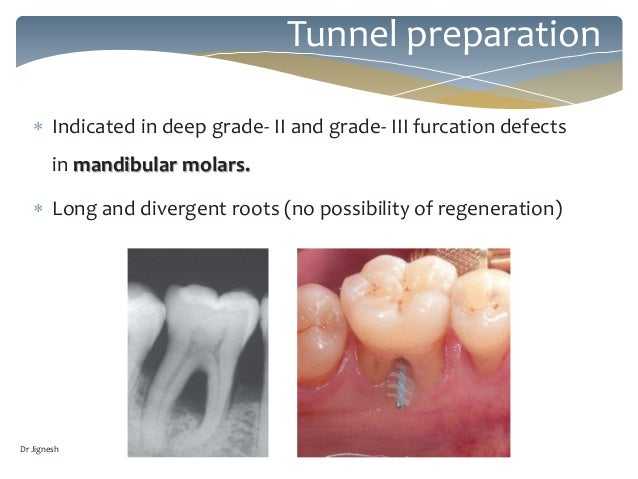 furcation involvement