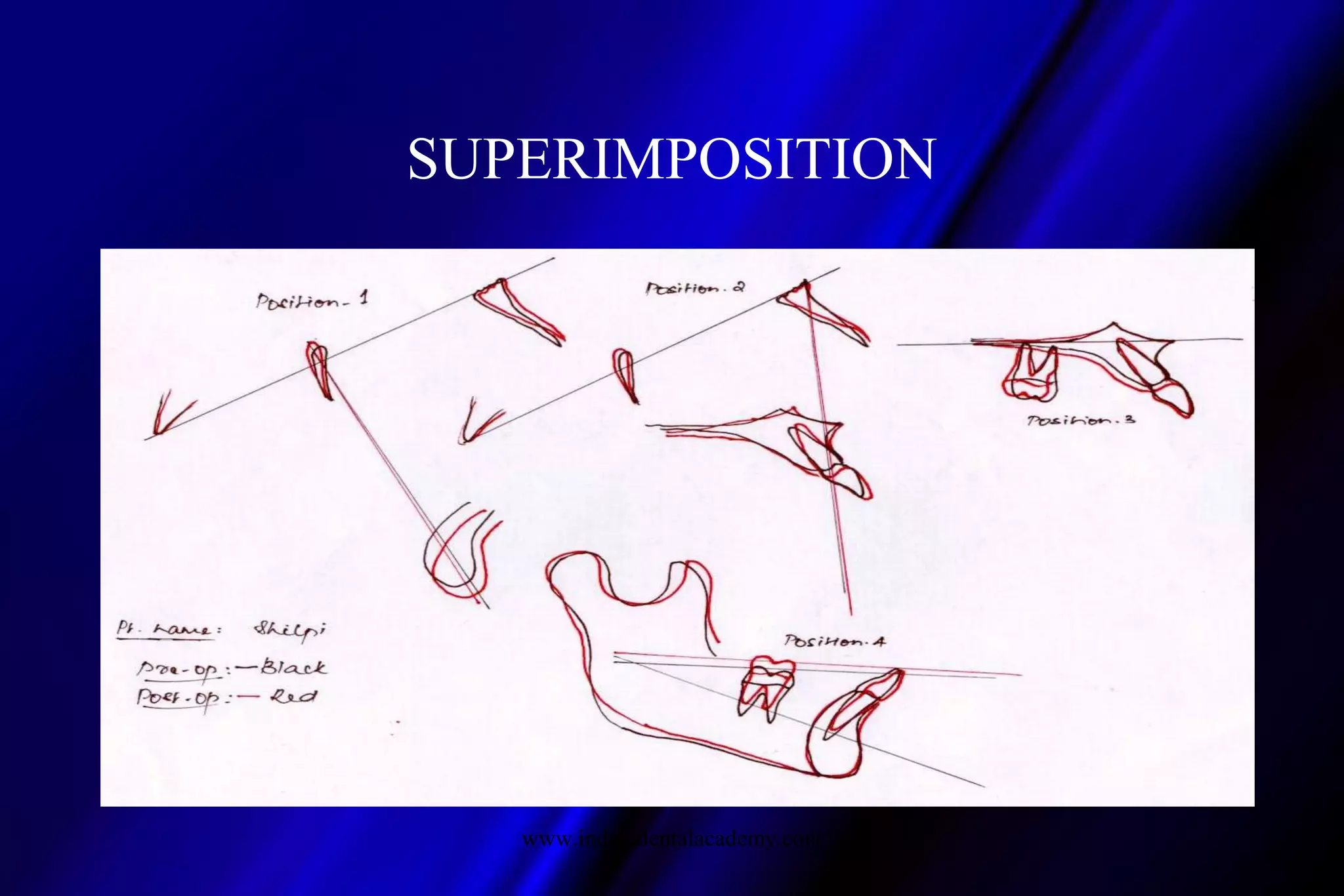 Bite jumpers-orthodontic potpourri | PPT
