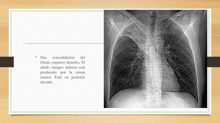Signos De Colapso Lobar Y Pulmonar Pptx