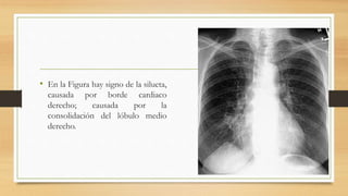 Signos de colapso lobar y pulmonar | PPTX