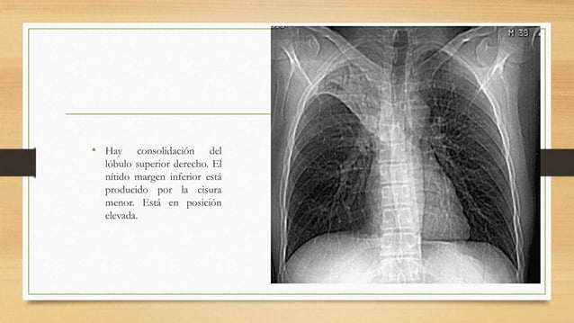 Signos de colapso lobar y pulmonar