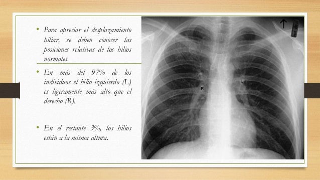 Signos de colapso lobar y pulmonar