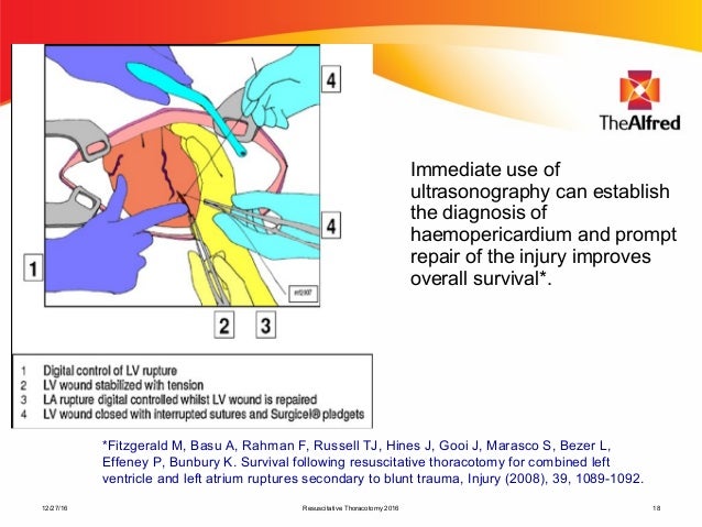 Resuscitative Thoracotomy - Mark Fitzgerald