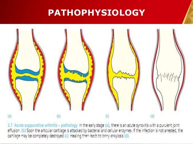 8. septic arthritis 30th dec 14