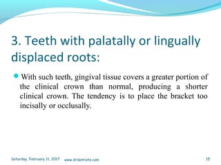 mbt bracket placement | PPT