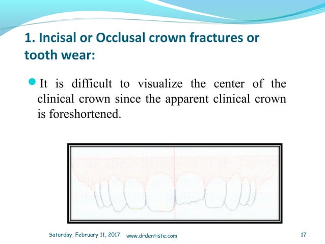 mbt bracket placement | PPT