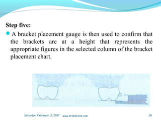 mbt bracket placement | PPT