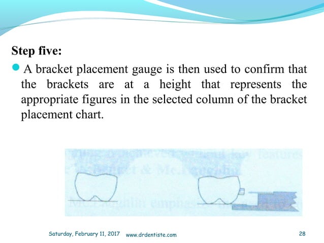 mbt bracket placement | PPT
