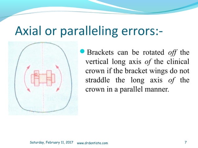mbt bracket placement | PPT