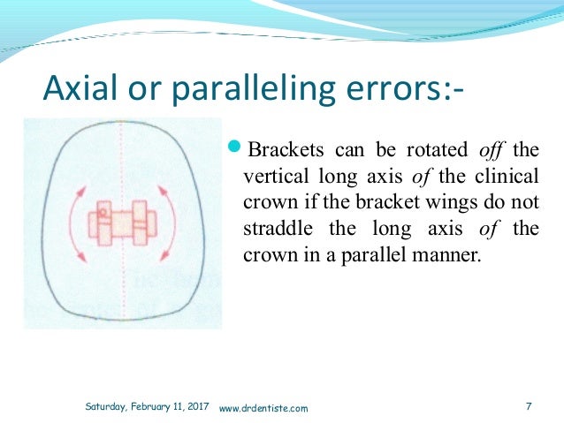 mbt bracket placement