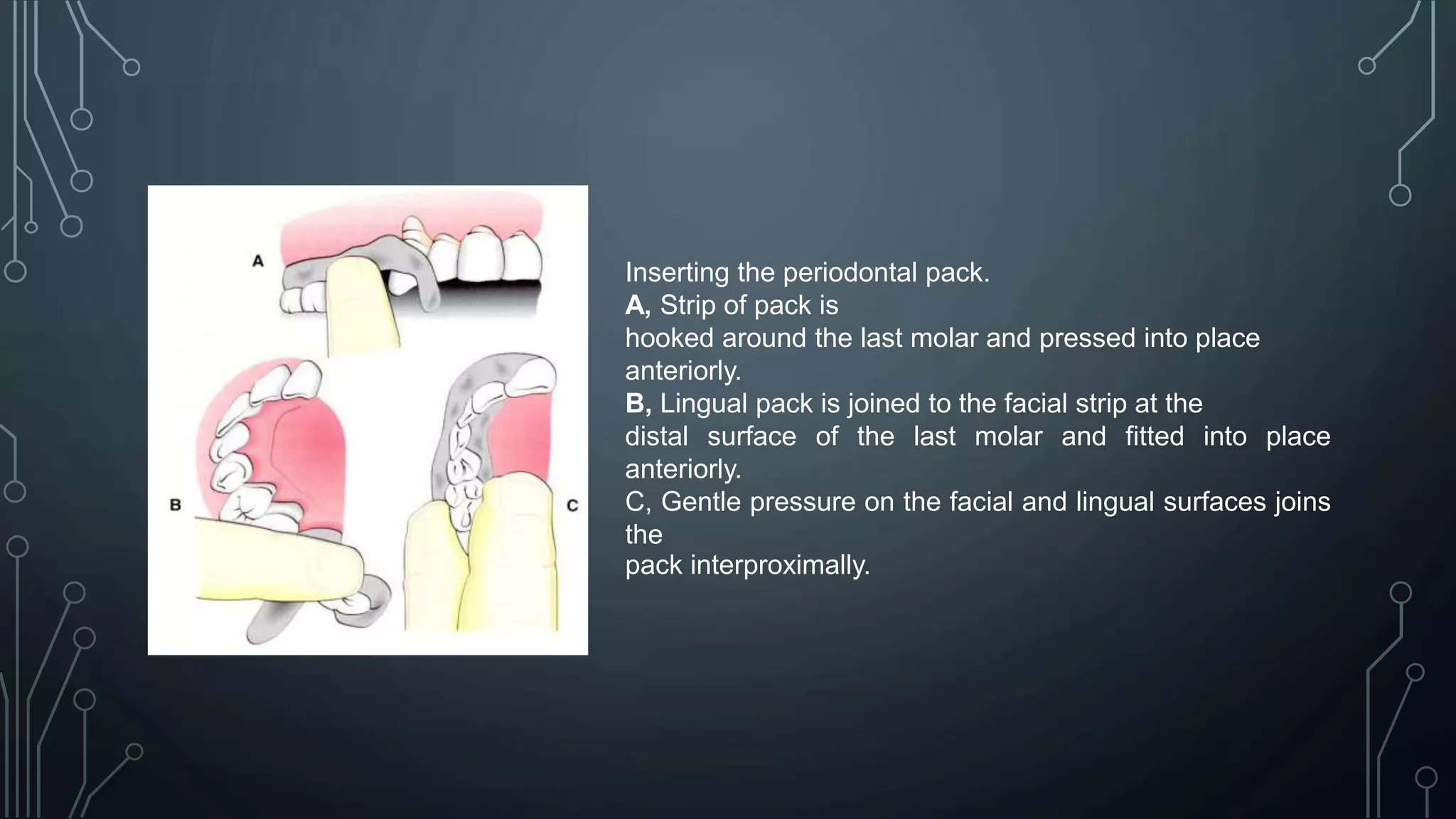 8.periodontal dressing | PPTX