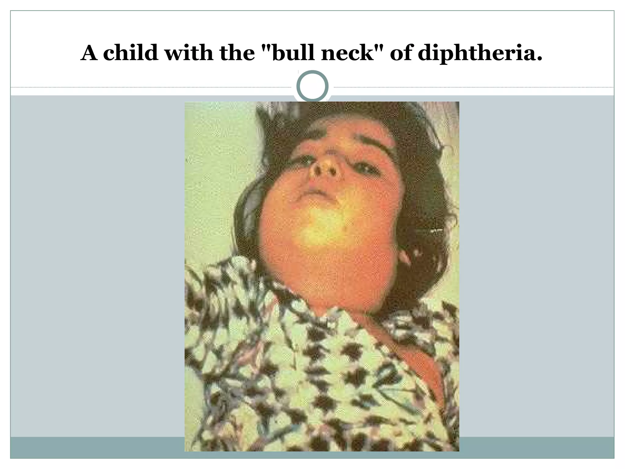 Diphtheria. Differential diagnostics of Acute tonsillitis | PPT
